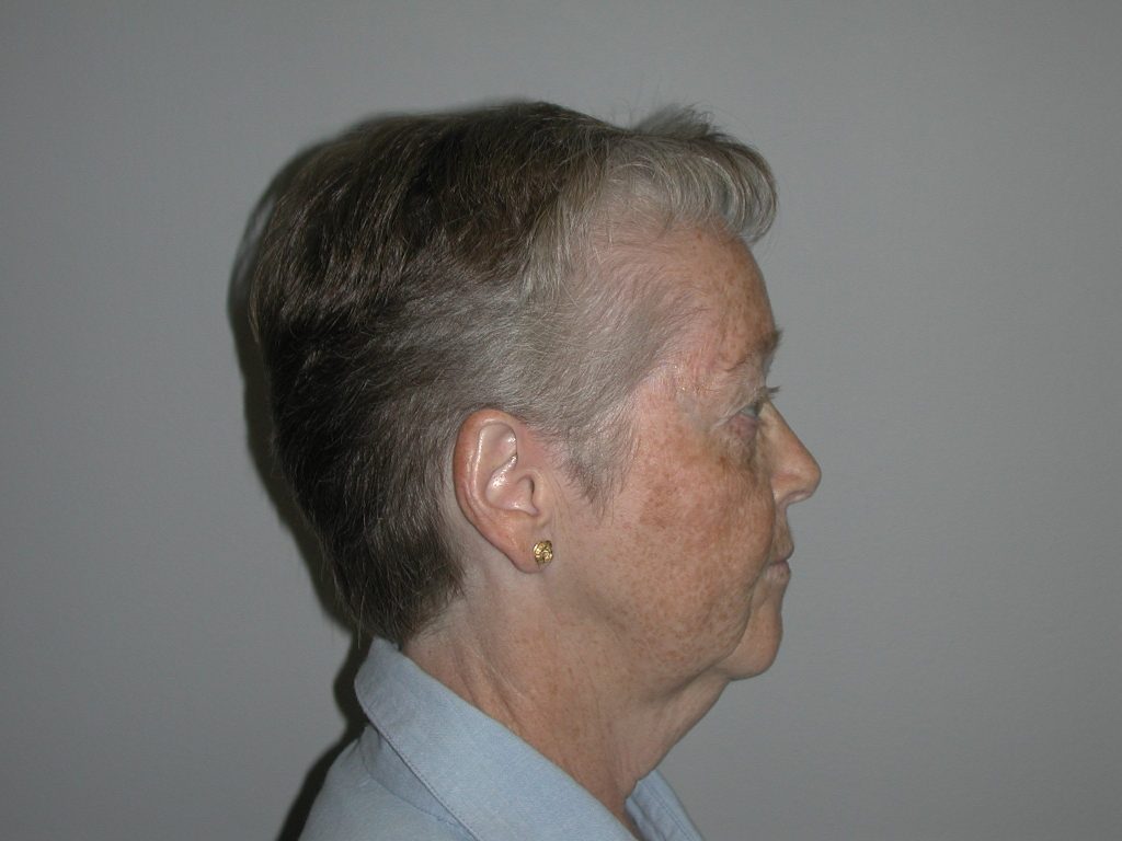 Neck Lift Gallery | Schaffer Plastic Surgery