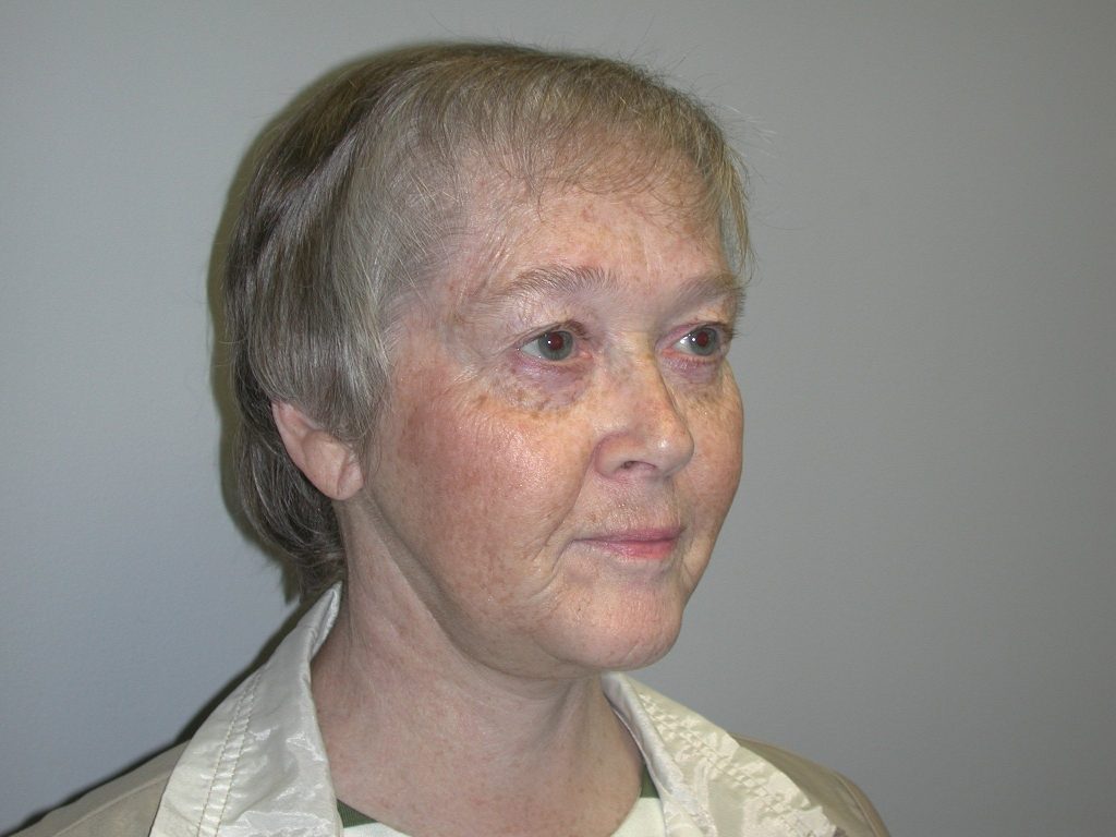 Neck Lift Gallery | Schaffer Plastic Surgery