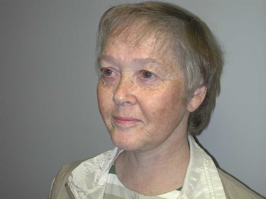 Neck Lift Gallery | Schaffer Plastic Surgery