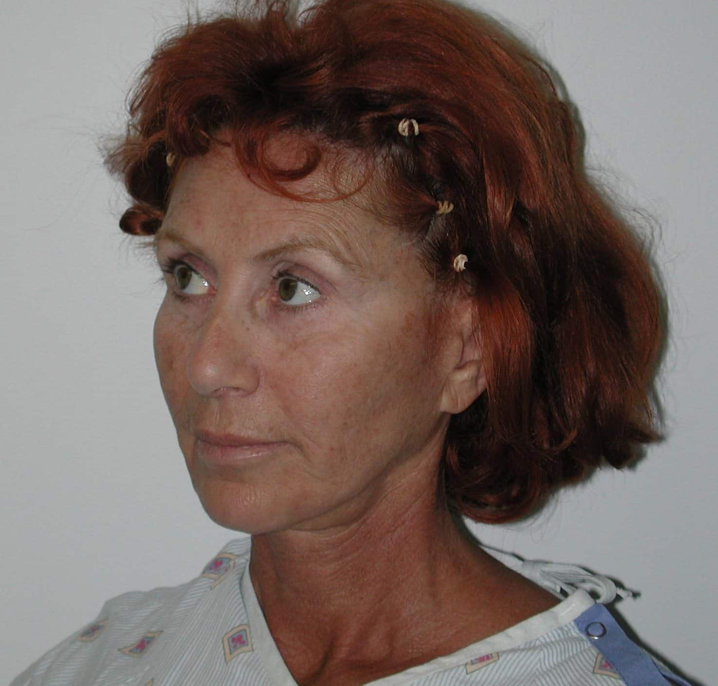 Facelift in Birmingham, AL - Schaffer Plastic Surgery