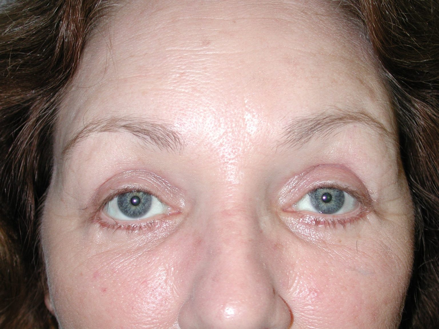 Brow Lift in Birmingham, AL