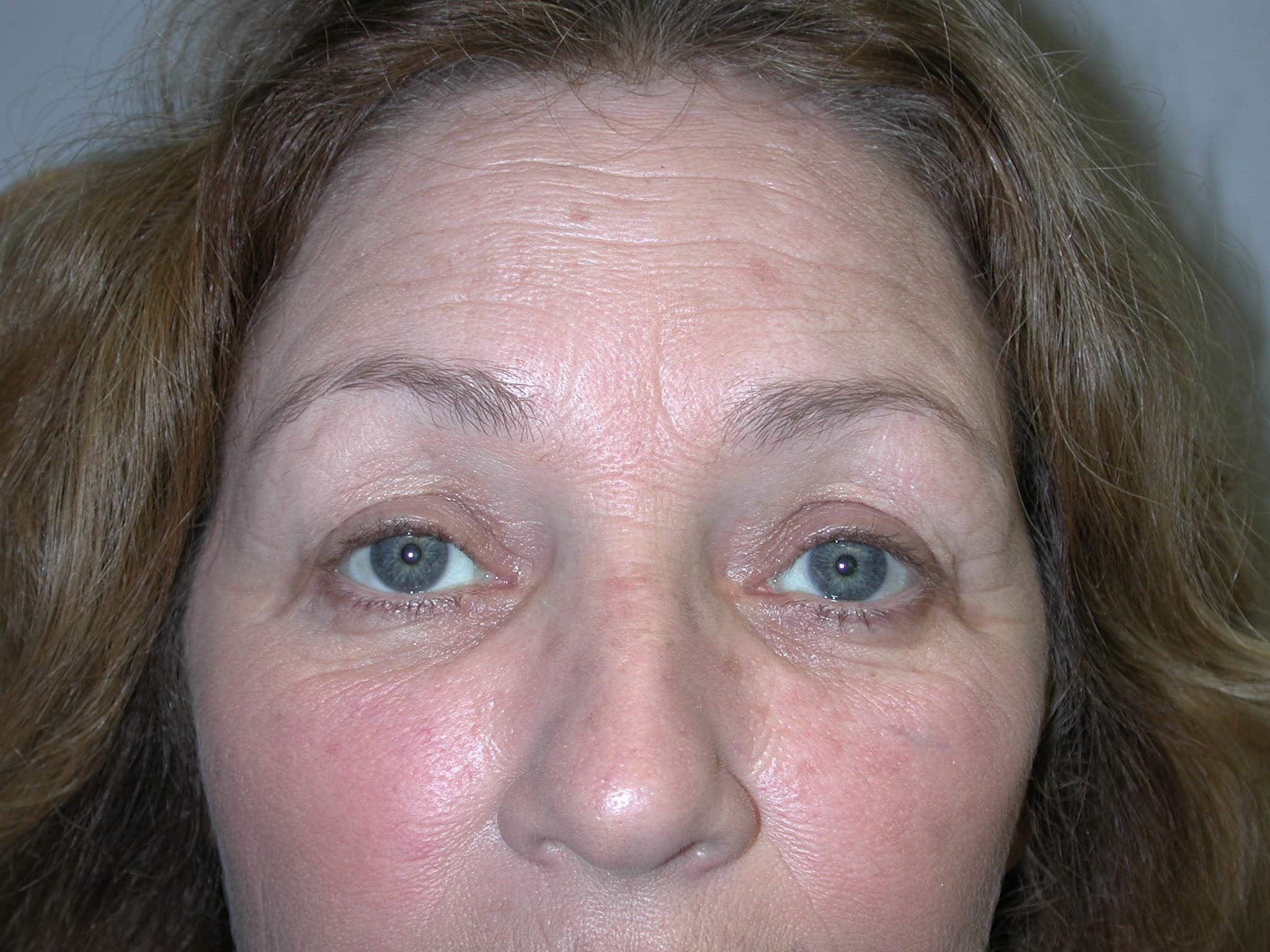 Brow Lift in Birmingham, AL