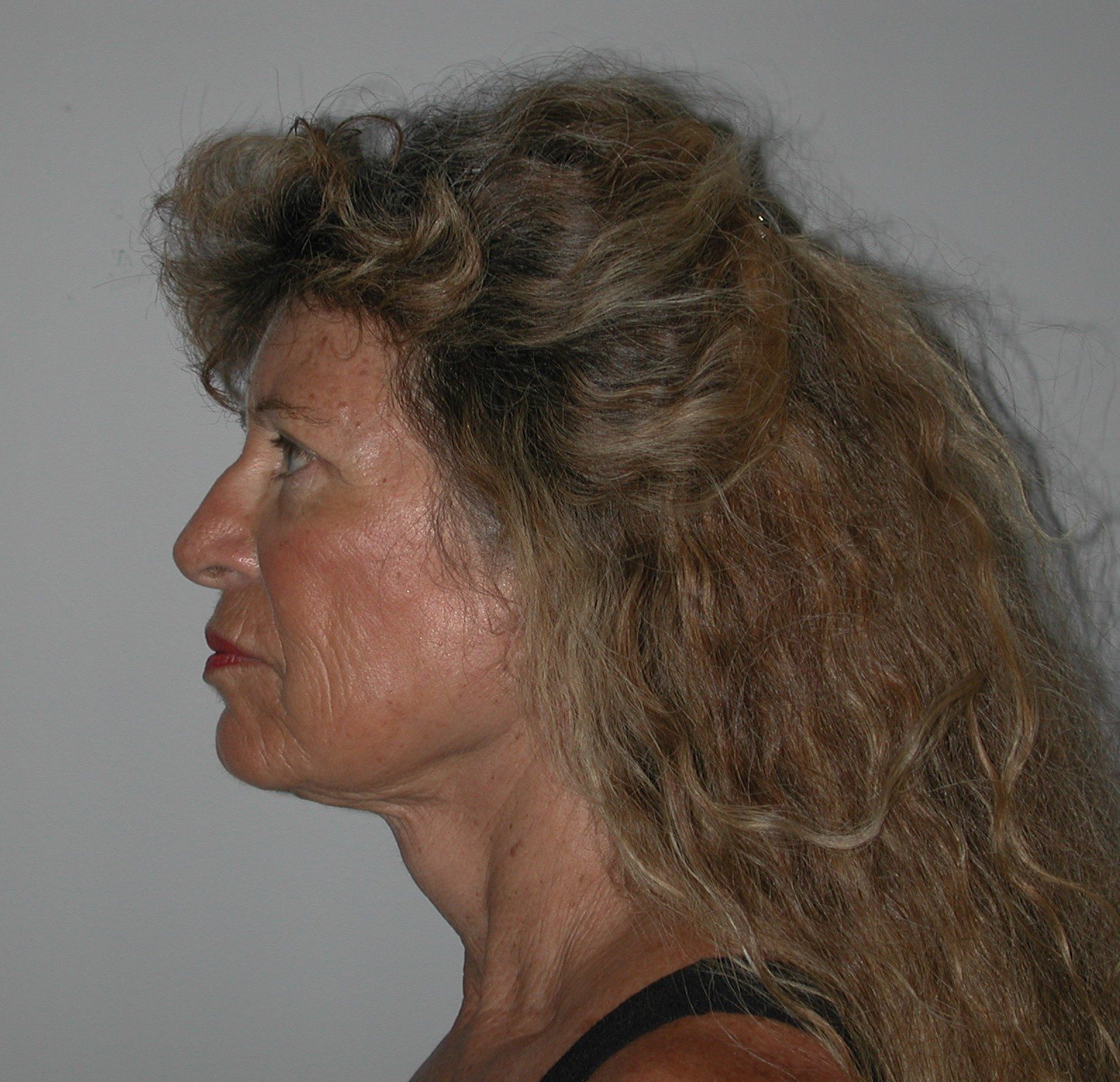 What is a Mini Neck Lift? | Birmingham, AL