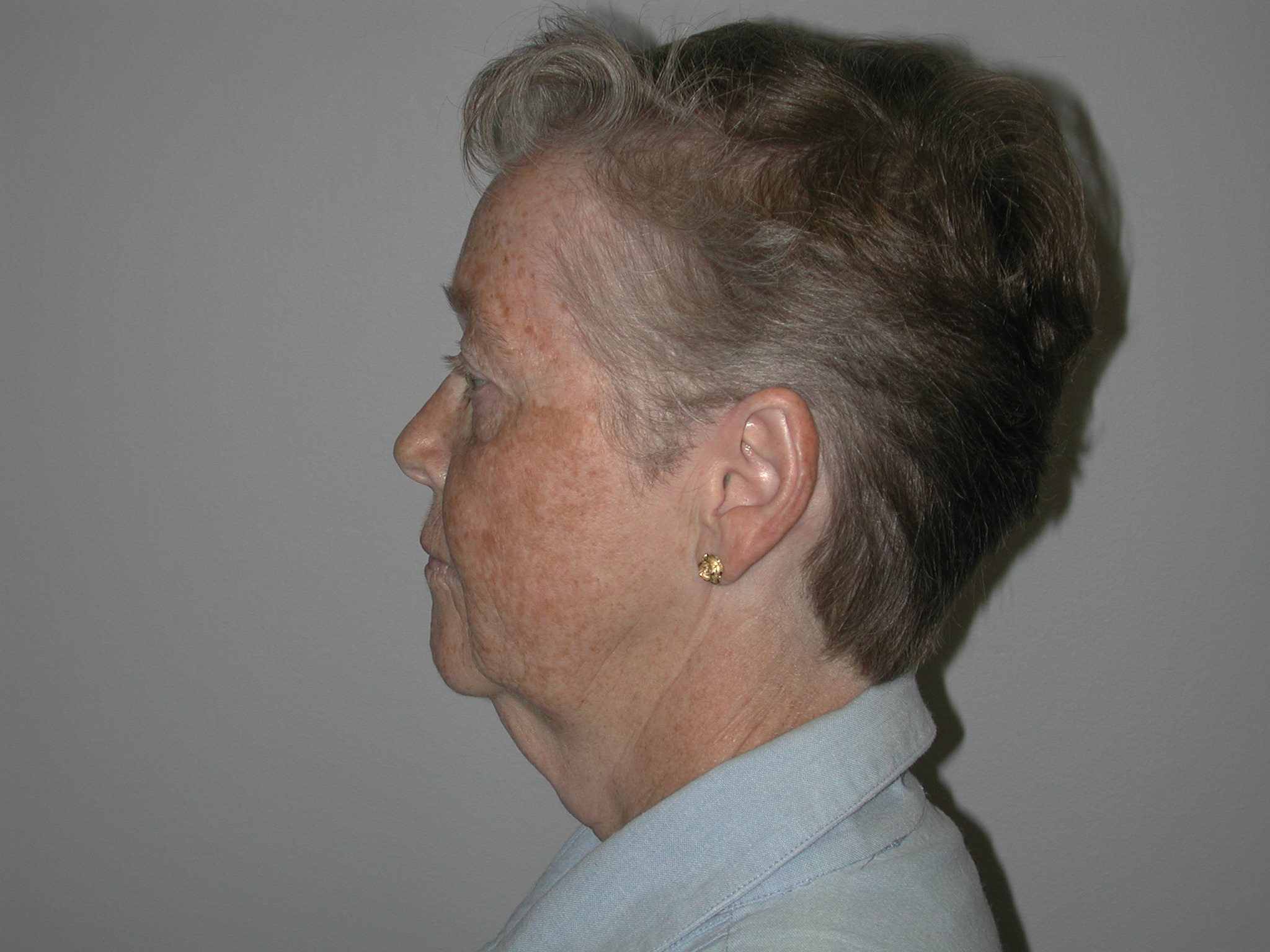 Neck Lift in Birmingham, AL